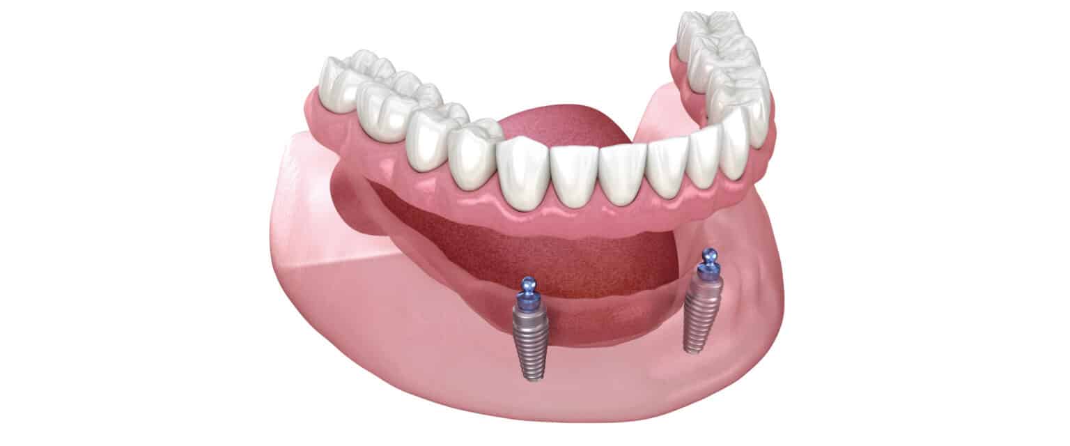 Implant-Supported Overdentures - Family Dental Centre