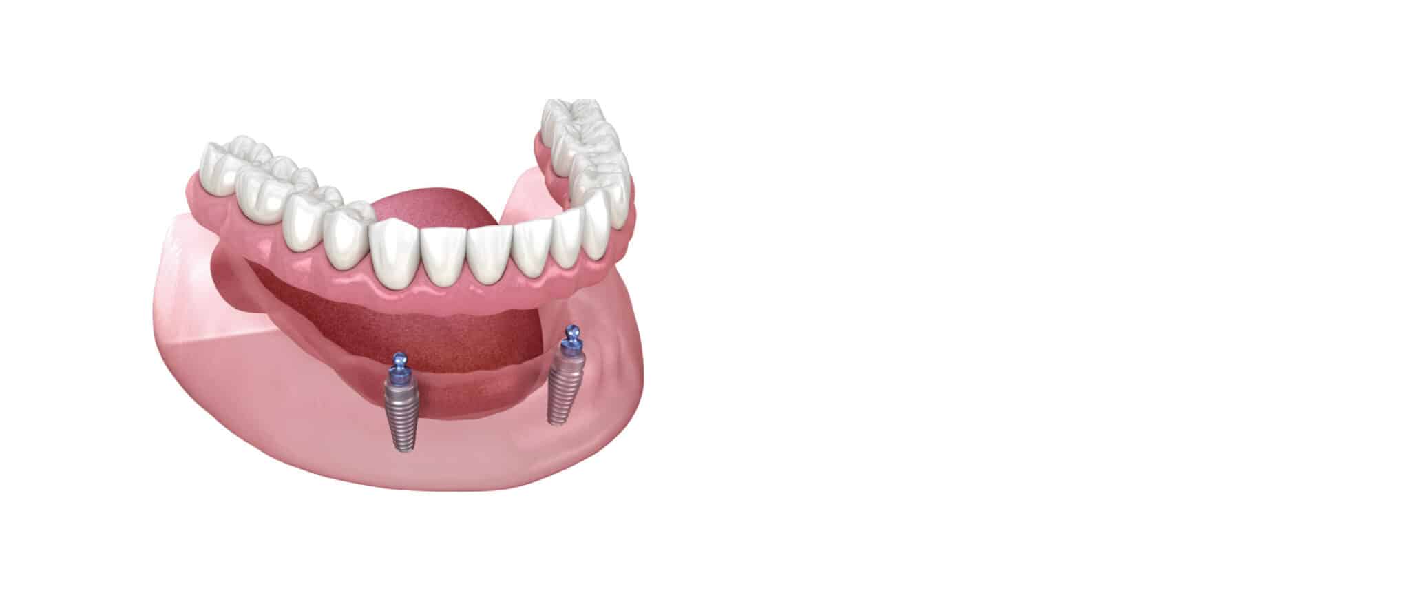 Implant-Supported Overdentures - Family Dental Centre